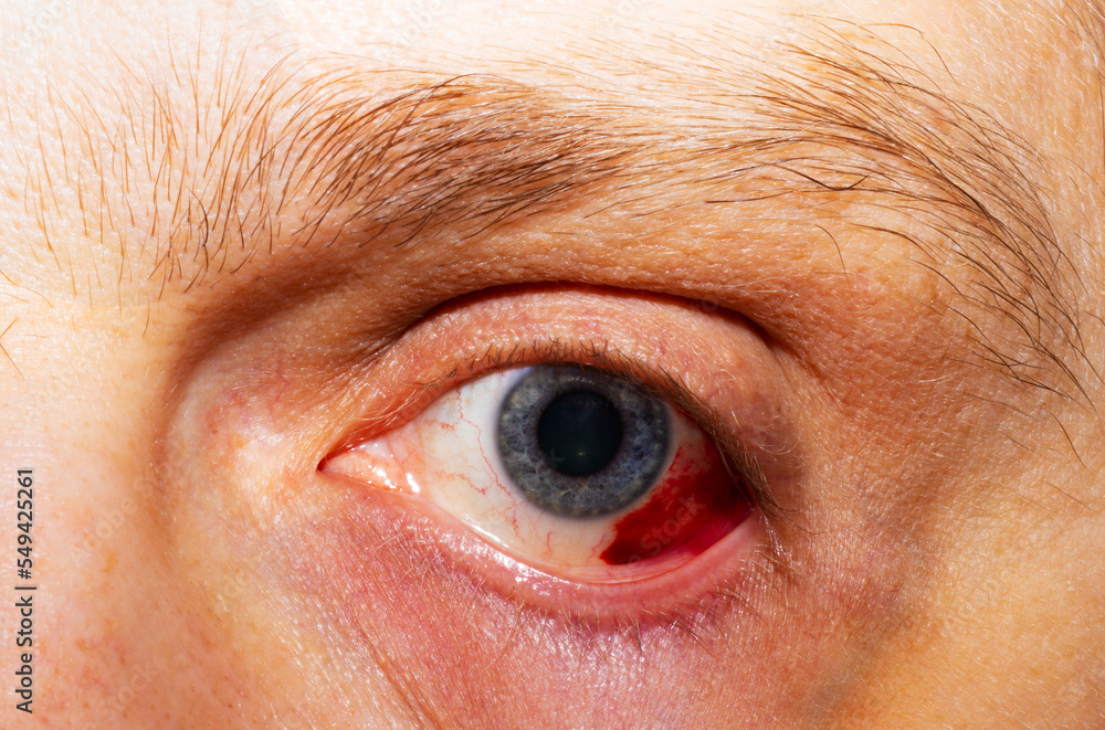 Hemorrhage of the eye, rupture of a vessel in the eye, blood in the eye ...