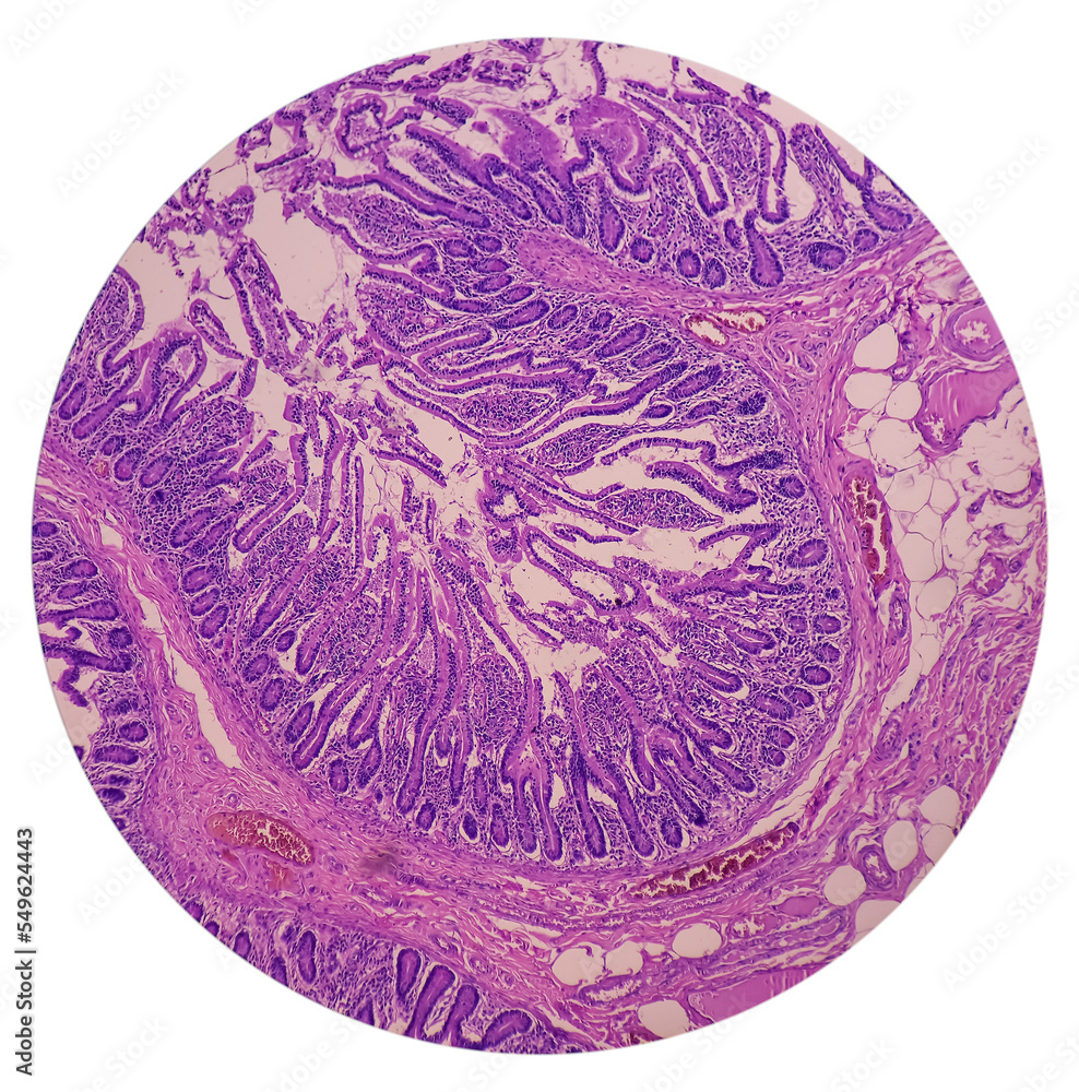 Intra abdominal mass with transverse colon(biopsy): Fibromatosis ...