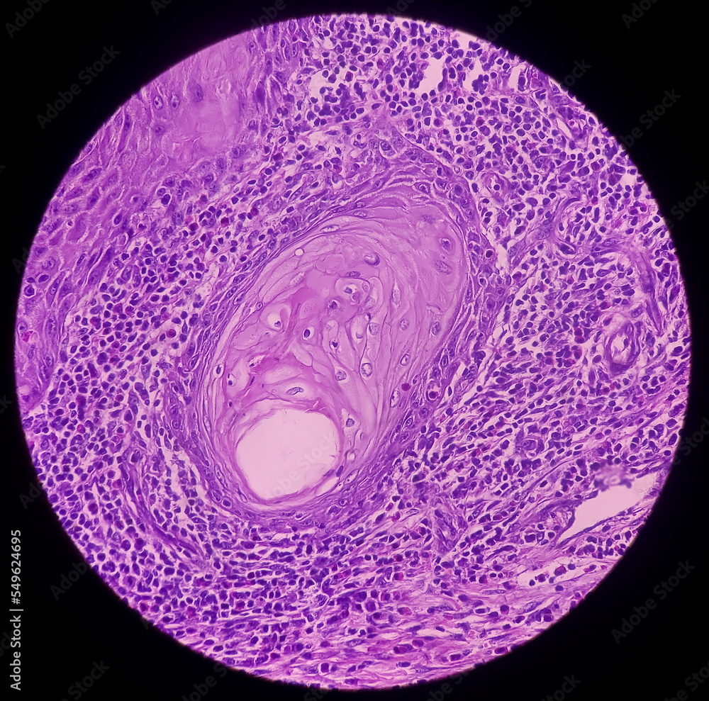 Finger biopsy, finger cancer, Invasive squamous cell carcinoma, grade ...