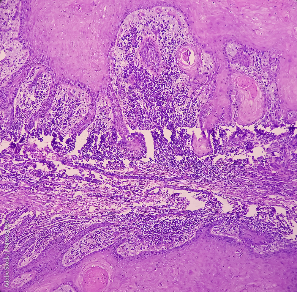 Finger biopsy, finger cancer, Invasive squamous cell carcinoma, grade-II. Show malignant ...