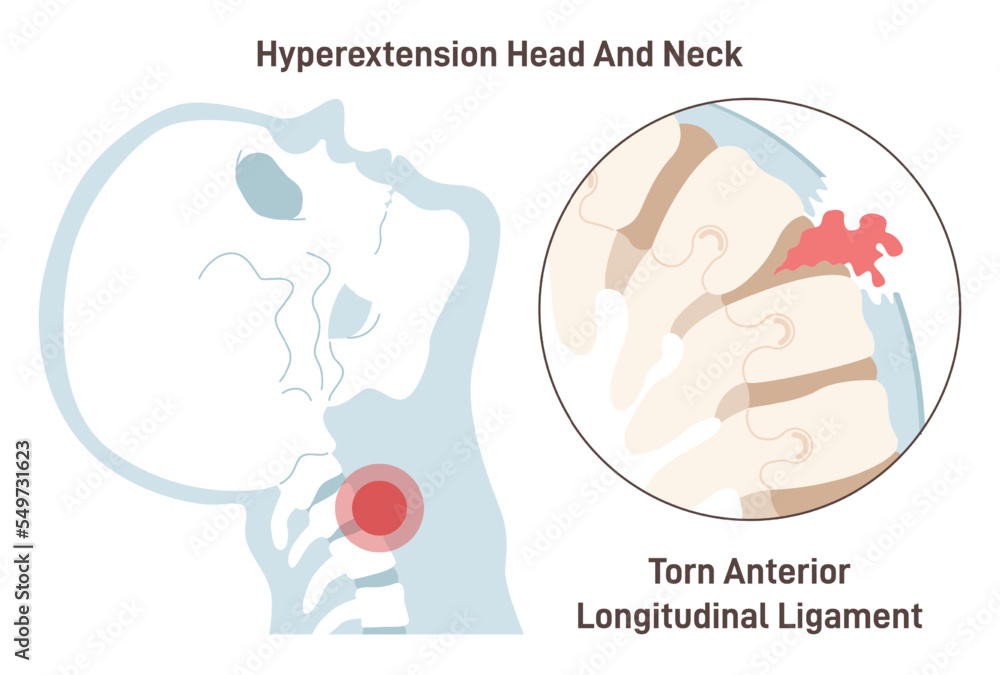 Vetor Neck hyperextension. Anterior longitudinal ligament torn. Spinal ...