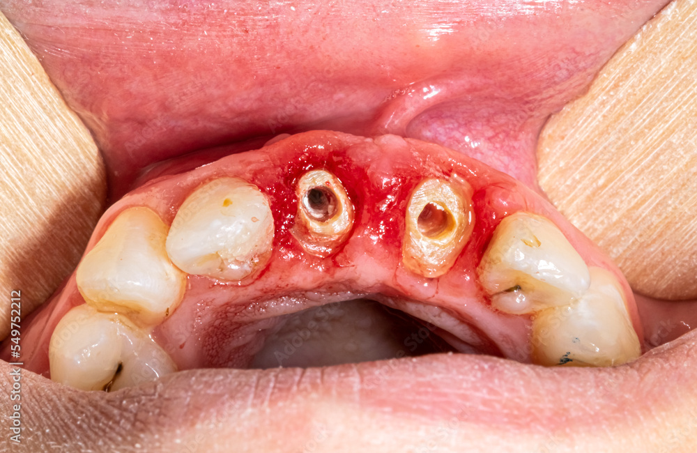 Stock-Foto „Occlusal view of decayed central incisal tooth with ...
