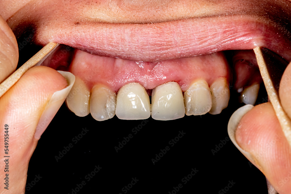 Frontal view of maxillary arch teeth, gum inflammatory and fixed ...