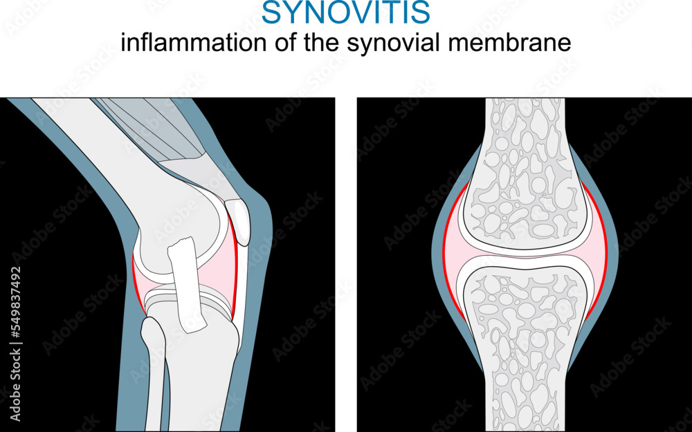 Synovitis. inflammation of the synovial membrane. Knee and Synovial ...