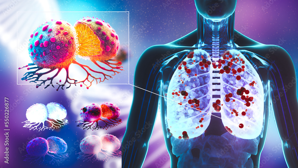 Illustration Stock Lung Cancer concept with human body X-ray revealing ...