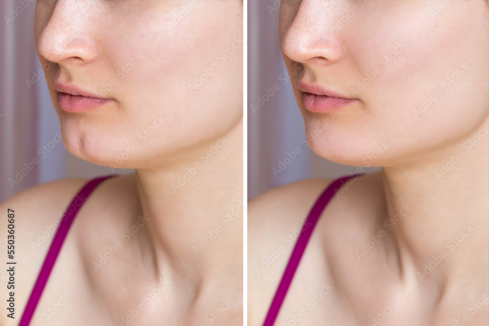 Filling the dimple on the chin with fillers. Woman's face with jaws and ...