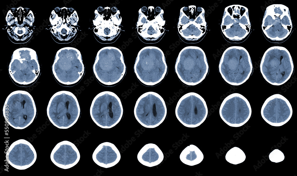 CT Brain Axial scans hyperdense mass with homogeneous, and mild ...