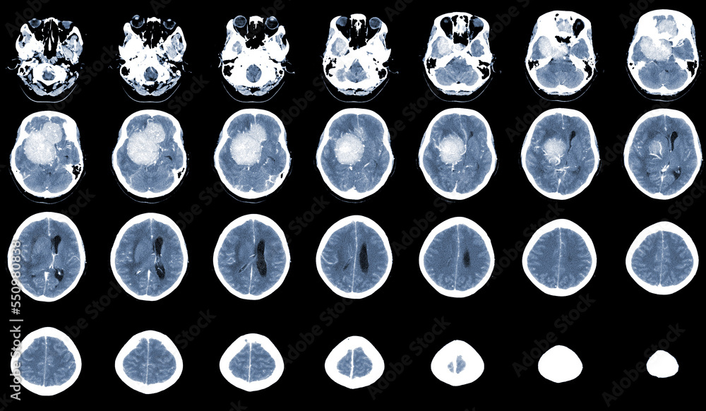 Foto de Stock CT Brain Axial scans hyperdense mass with homogeneous ...
