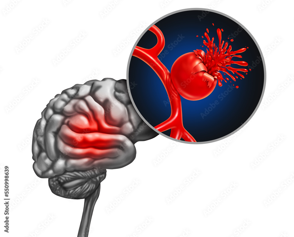 Ilustración de Stock Ruptured brain Aneurysm as a medical concept with ...