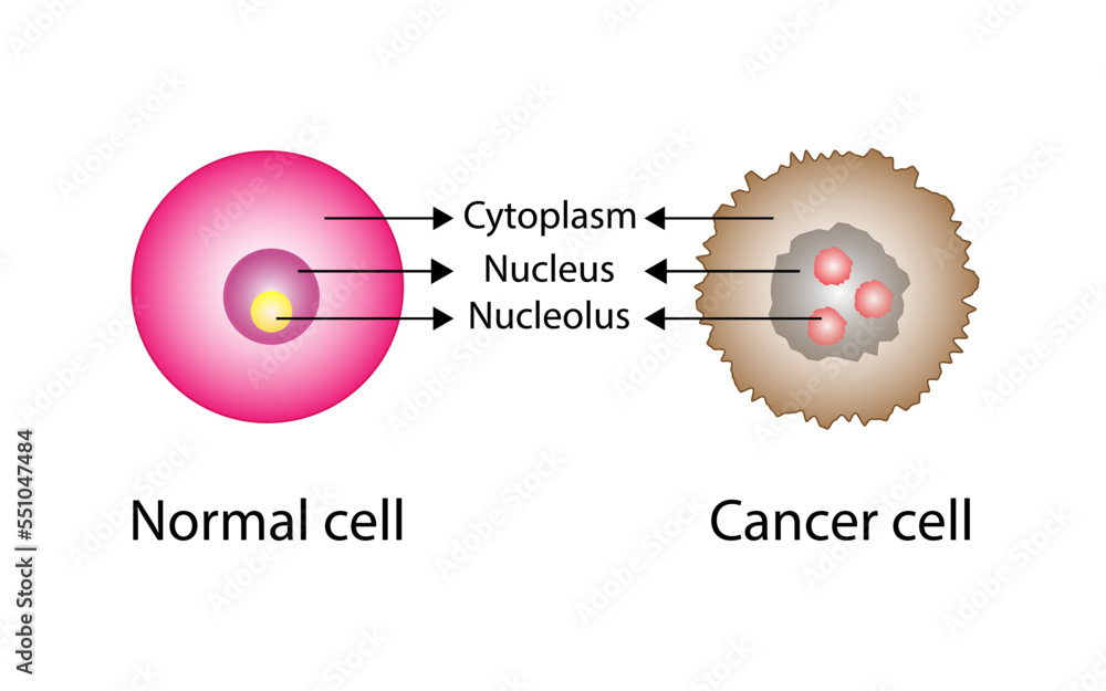 Normal cell and cancer cell. Difference between normal and tumor cell. Scientific design. Vector ...