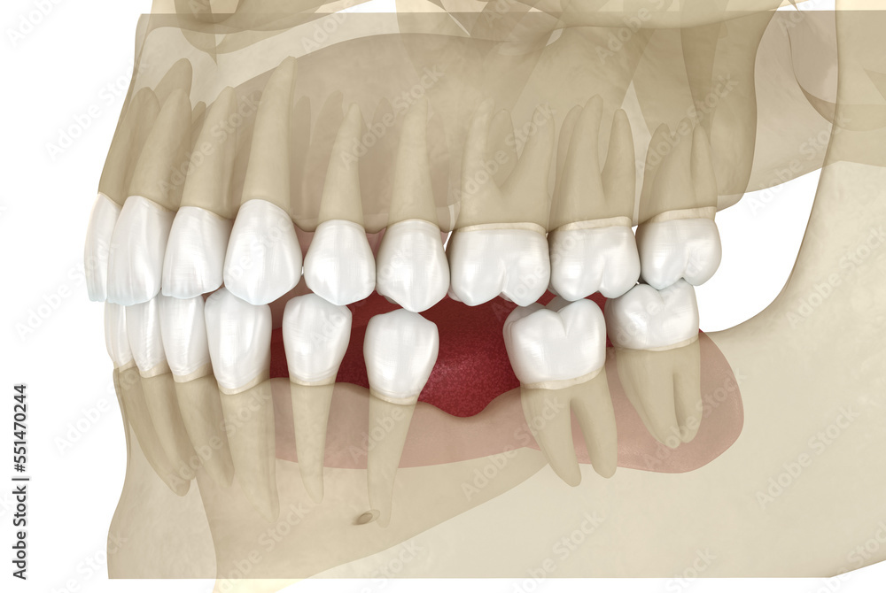 Teeth shift deformatiuon after losing molar tooth. 3D illustration of ...