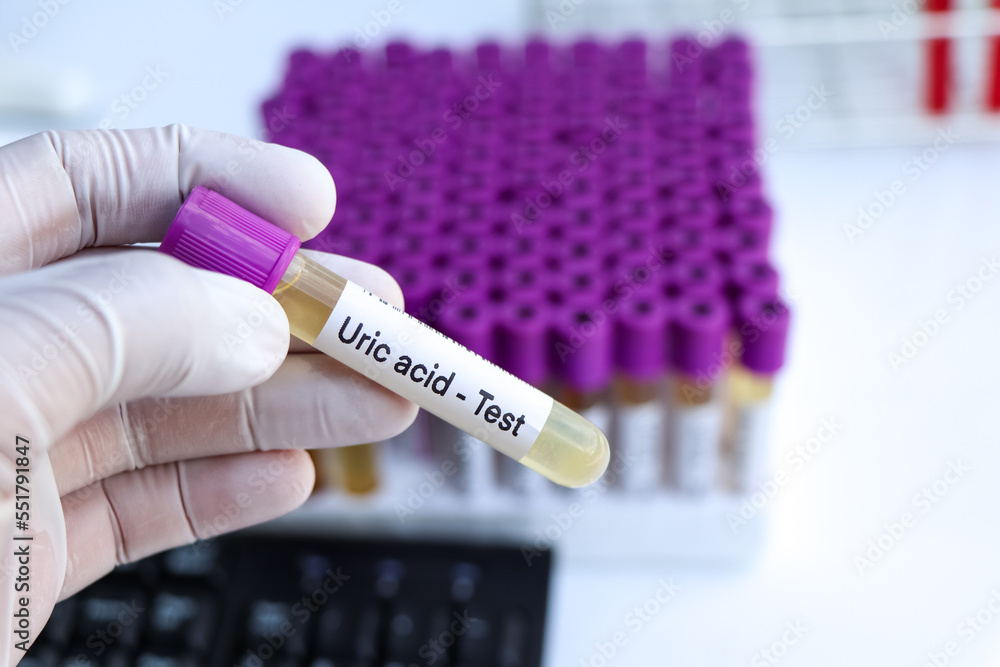 Uric acid test to look for abnormalities from Urine, Urine sample to ...