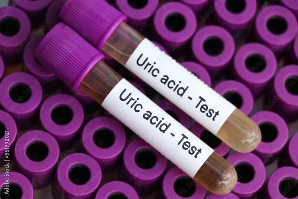 Uric acid test to look for abnormalities from Urine, Urine sample to ...