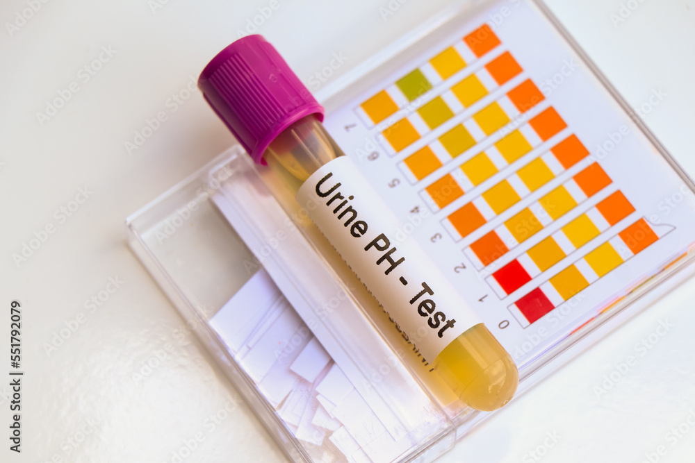 Urine PH test to look for abnormalities from Urine, Urine sample to ...
