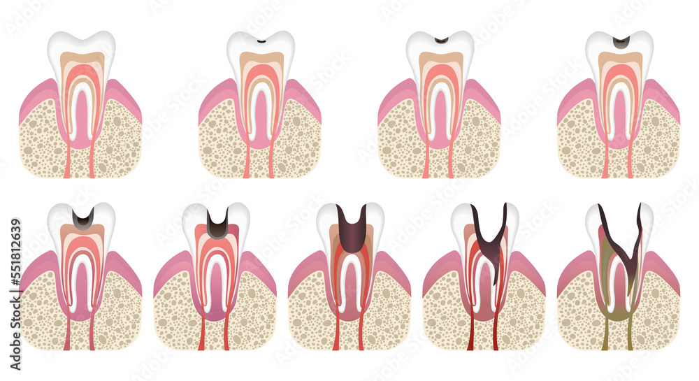 Stages of caries development. Tooth structure in flat style. Tooth ...