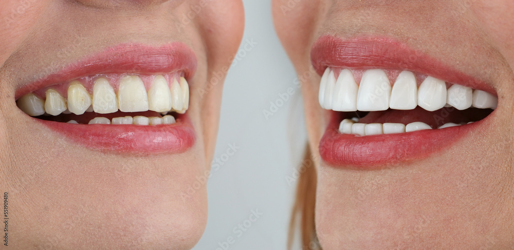 before after shot smile makeover Stock Photo | Adobe Stock