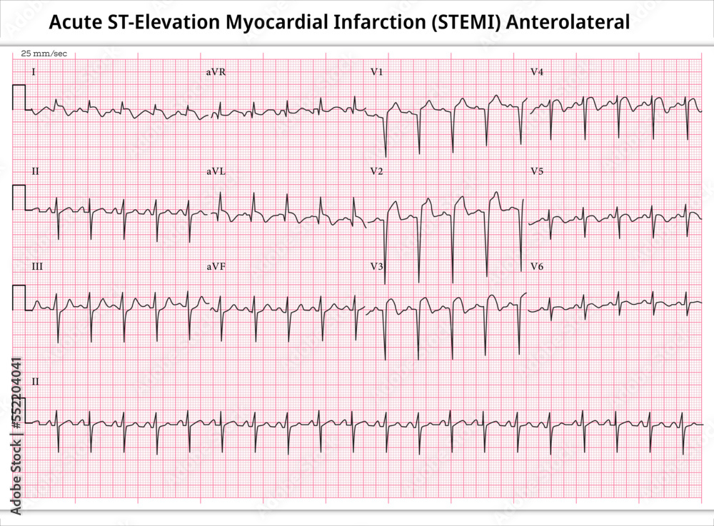 Acute St Elevation Myocardial Infarction Stemi Anterolateral Ecg Paper 12 Lead Stock Vector
