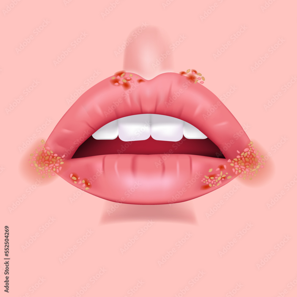 rash on lips, herpes. Pimples and ulcers on the face. Open mouth with ...