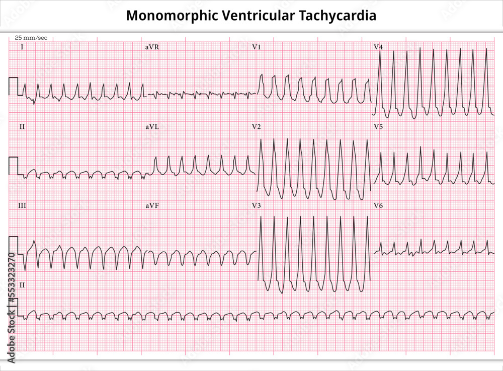 ECG Monomorphic VT - Ventricular Tachycardia - 12 Leads ECG Paper ...