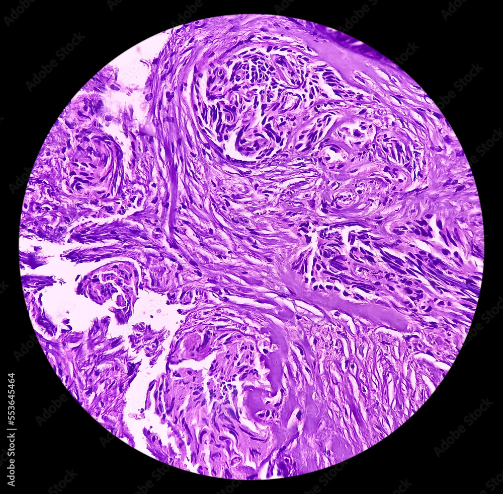 High grade mucoepidermoid carcinoma of parotid cyst. Microscopic show ...