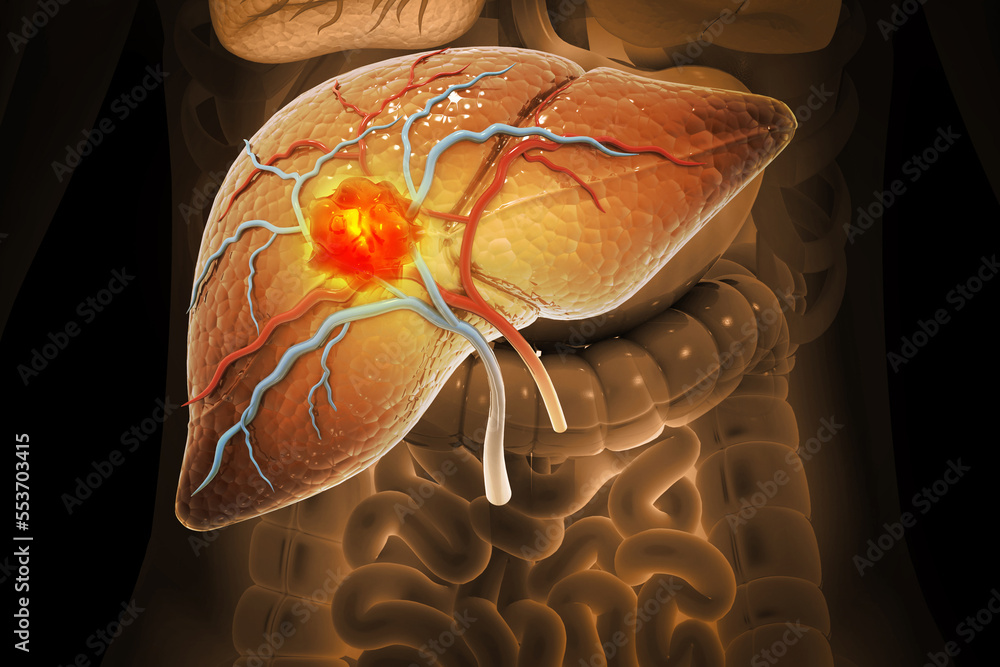Liver cancer, Hepatocellular Carcinoma (HCC), conditions, causes and ...