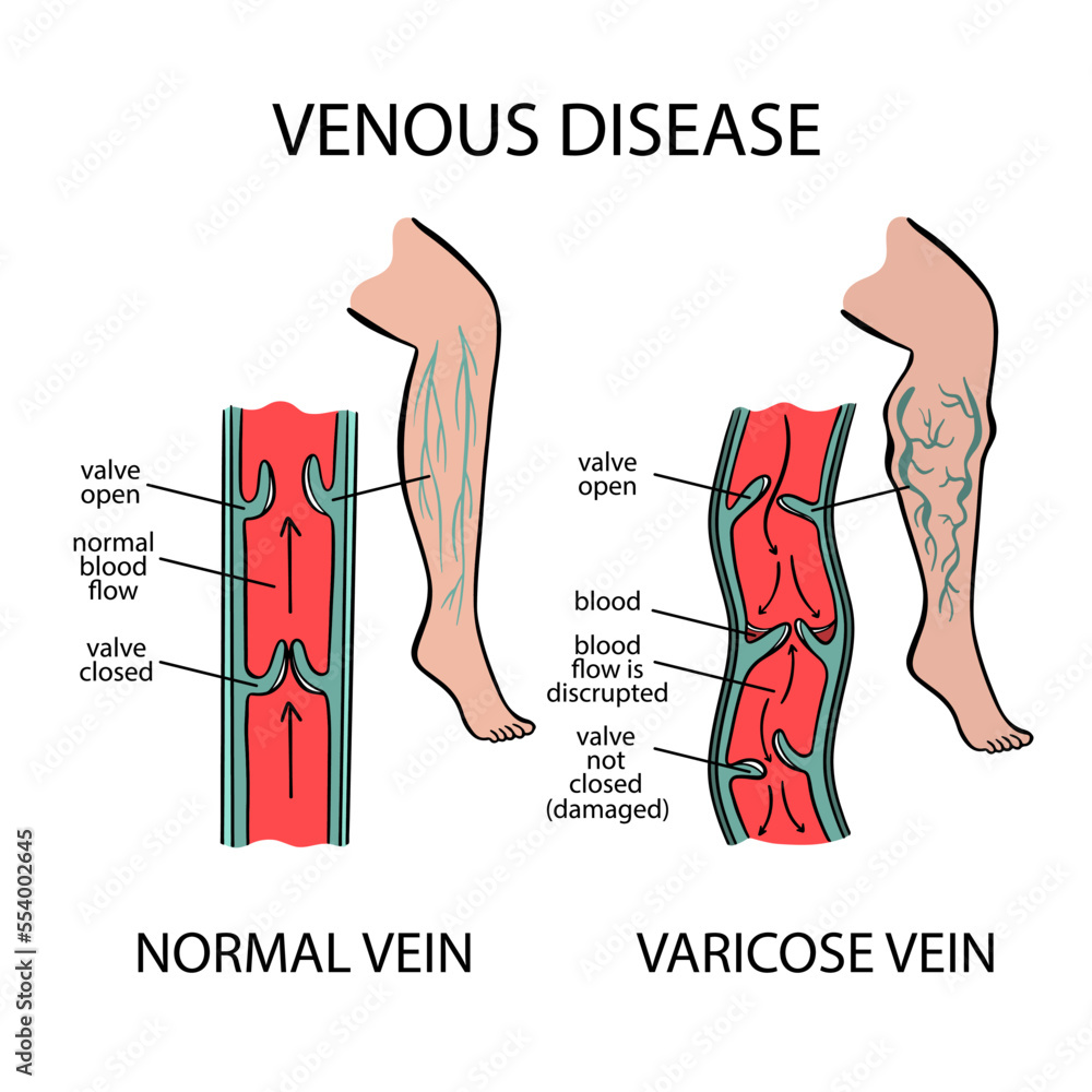 VARICOSE VEINS Venous Disease Of Human Legs Twisting And Dilation Of ...