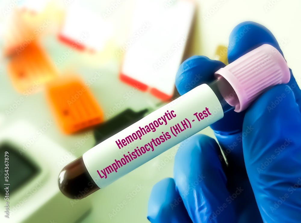 Blood sample for HLH or Hemophagocytic Lymphohistiocytosis, a rare ...