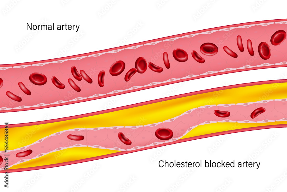 Normal artery and cholesterol blocked artery. Clogged arteries caused ...