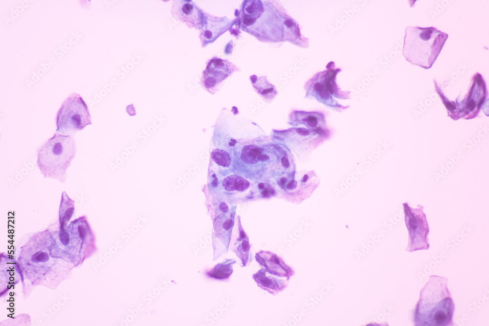iew in microscopic of Abnormal human cervix cells.Squamous epithelium ...