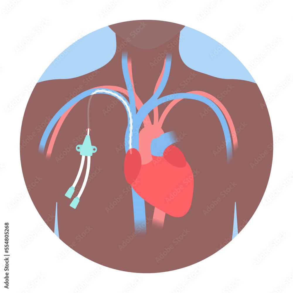 Tunneled central venous catheter placed in the subclavian vein. Patient ...