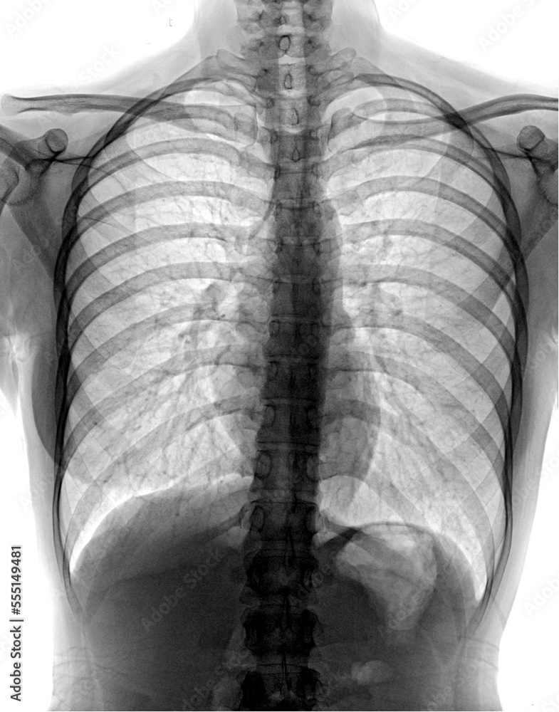 Bronchiectasis . X-ray chest show multiple lung bleb and cyst due to ...