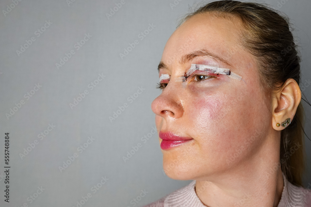woman face after plastic surgery, blepharoplasty operation, swelling ...