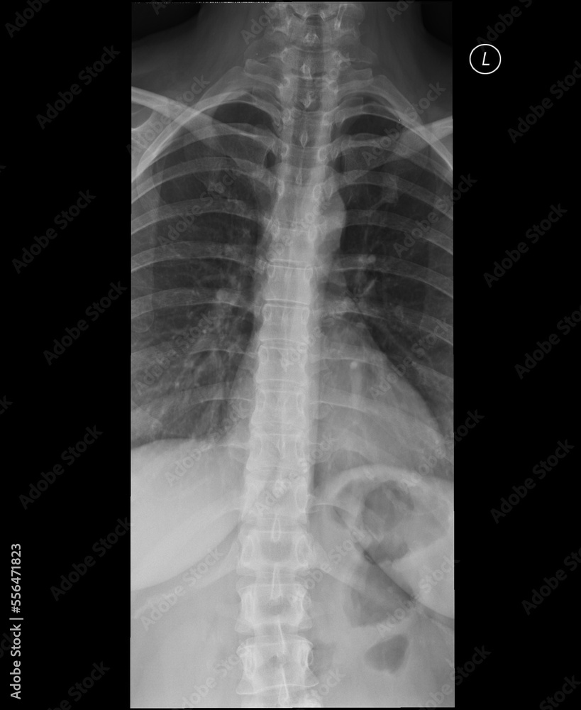 Thoracic spine x-ray. AP view. A significant kyphosis with mild right ...