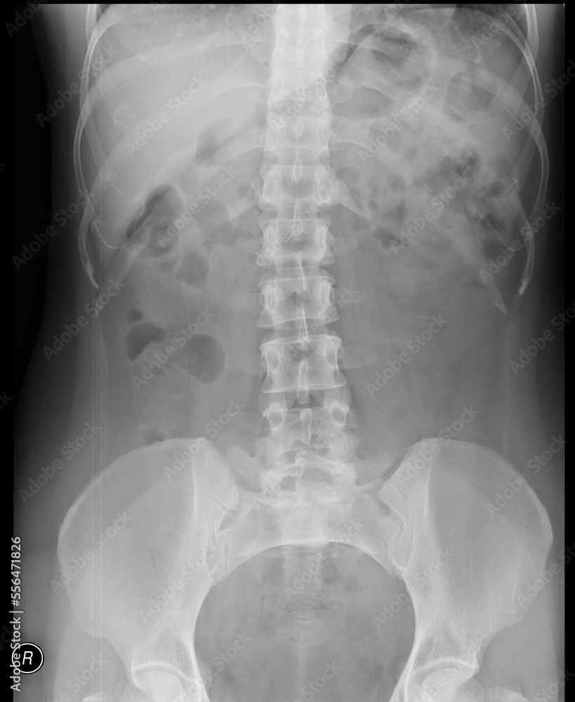 Lumbosacral spine x-ray. AP view. Lumbar lordosis with mild right ...