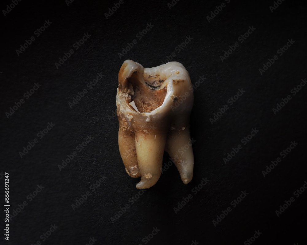 Foto de Stock Tooth decay on black background. Macro shot of a decayed ...