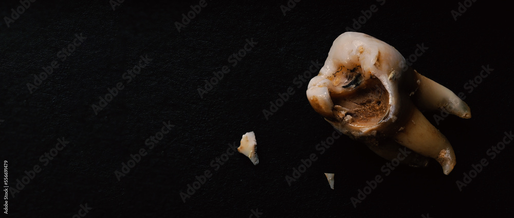 Foto de Stock Tooth decay on black background. Macro shot of a decayed ...
