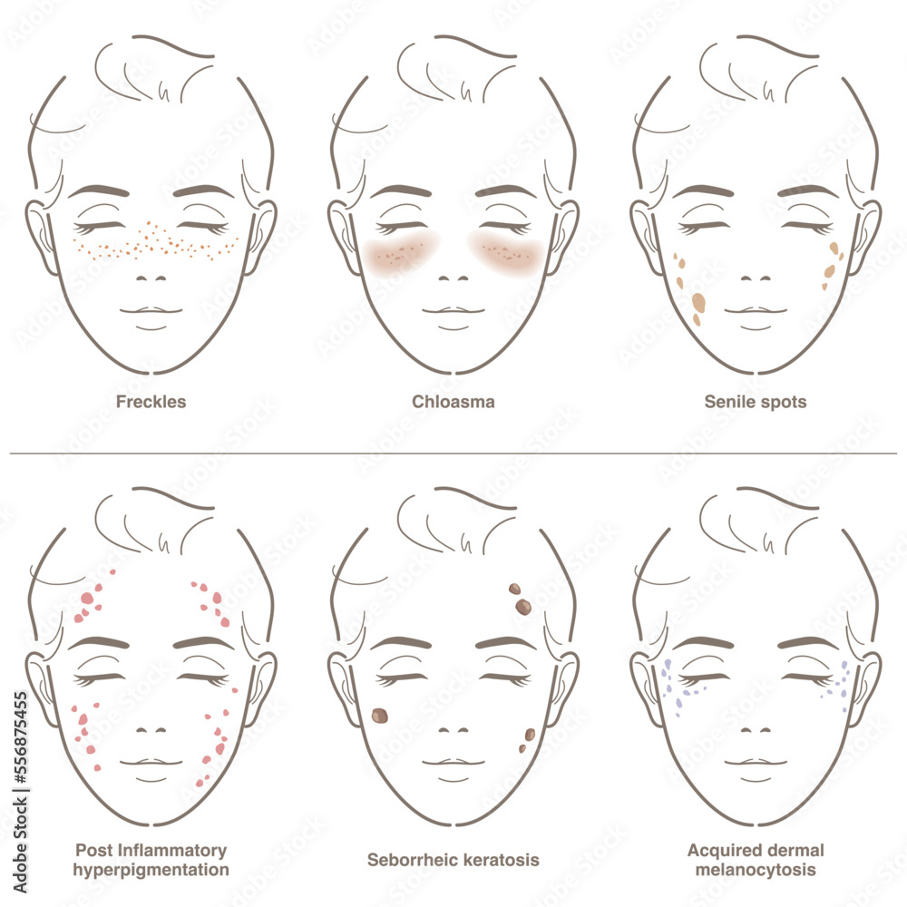6 types of facial age spots. Vector illustration drawing. Stock Vector ...