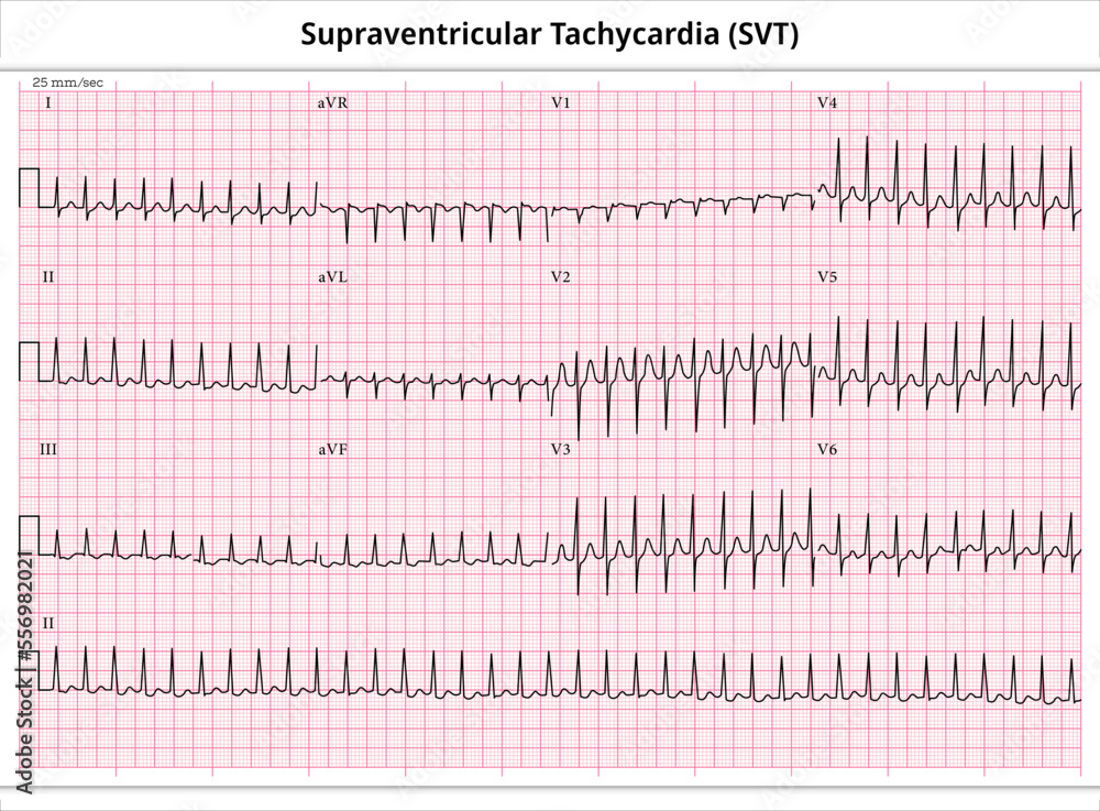 ECG Supraventricular Tachycardia - 12 Leads ECG Paper Stock Vector ...