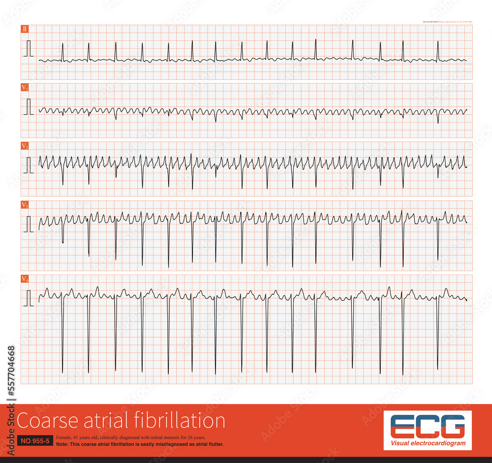 Sometimes, coarse atrial fibrillation is easily misdiagnosed as atrial ...