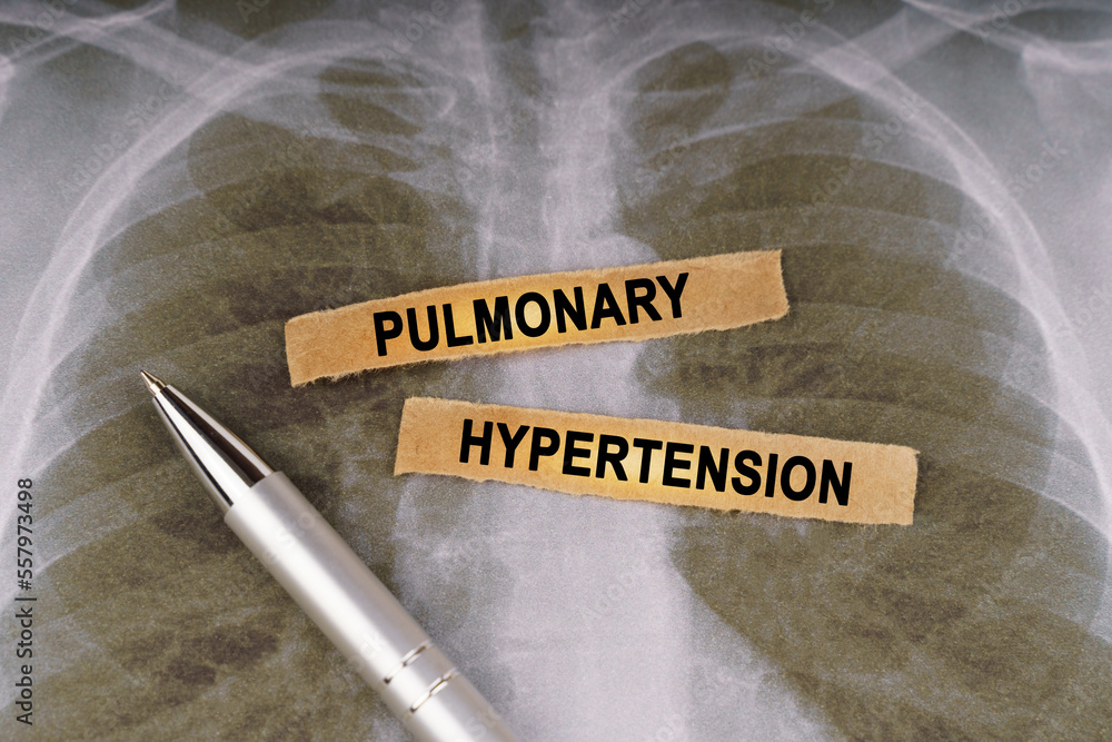 On a human chest x-ray, a pen and strips of paper labeled - Pulmonary ...