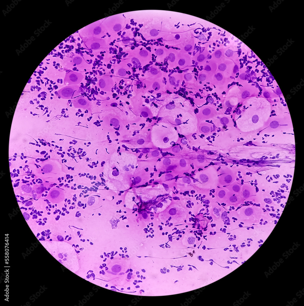 Pap's smear. Reactive cellular changes associated with severe ... Pap's smear. Reactive cellular changes associated with severe ...