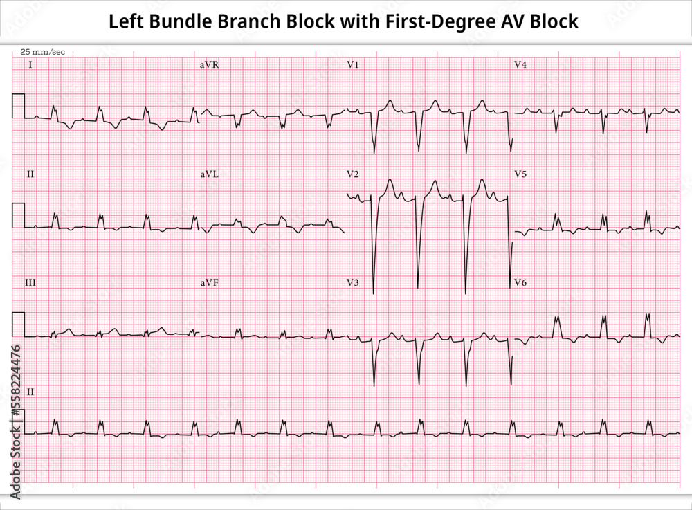 Image vectorielle Stock ECG First-Degree AV Block with LBBB (Left ...