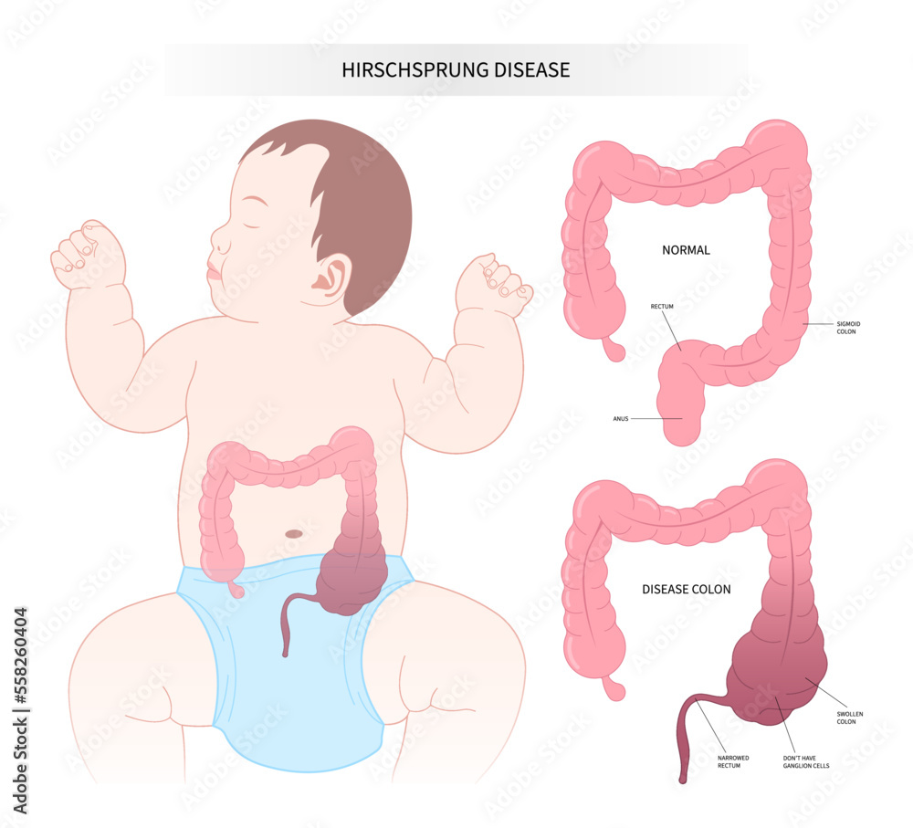 Baby diarrhea disorder intestinal disease of Hirschsprung's nerves ...