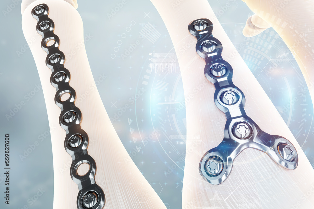 Medical procedure, osteosynthesis operation, surgical repositioning of ...