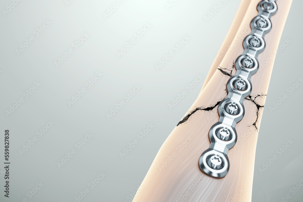 Ilustración de Stock Medical procedure, osteosynthesis operation ...