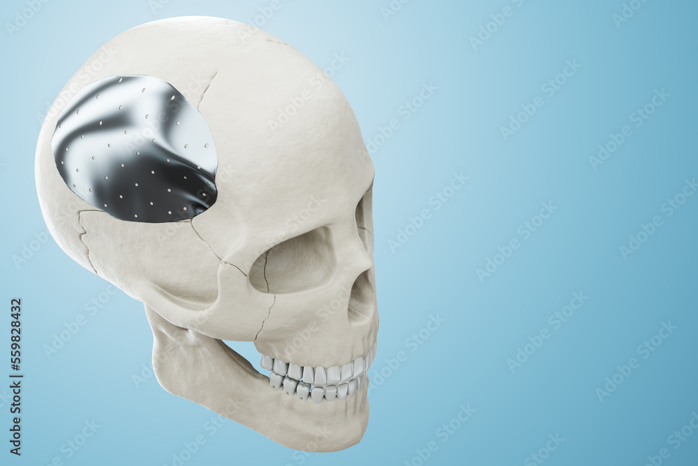 Medical procedure, osteosynthesis operation, surgical reposition of the ...