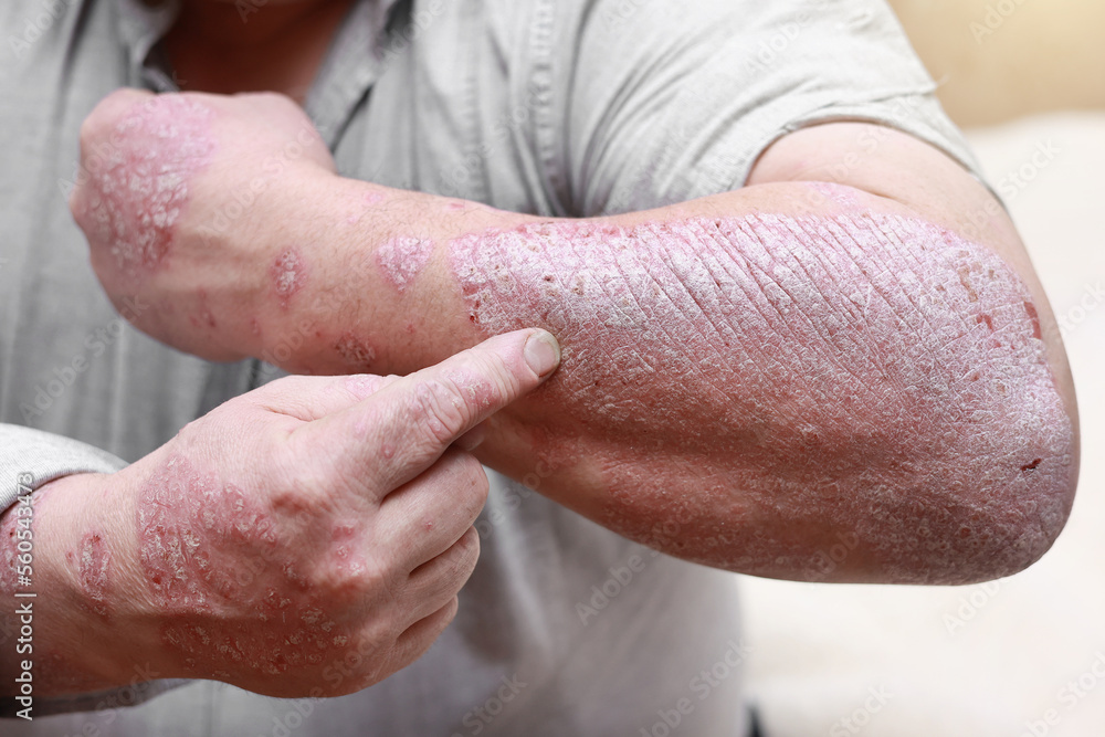 Acute form of psoriasis skin. Male showing arm with cracked, hard ...