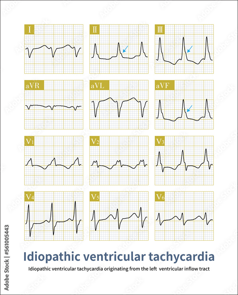 This case of ventricular tachycardia originated from the left ...