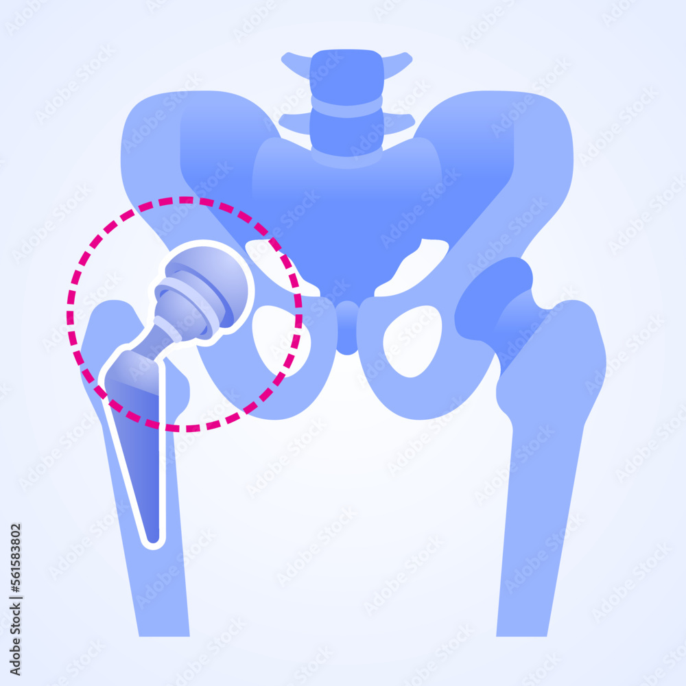 Titanium joint. Total hip replacement or arthroplasty. Structure of the ...
