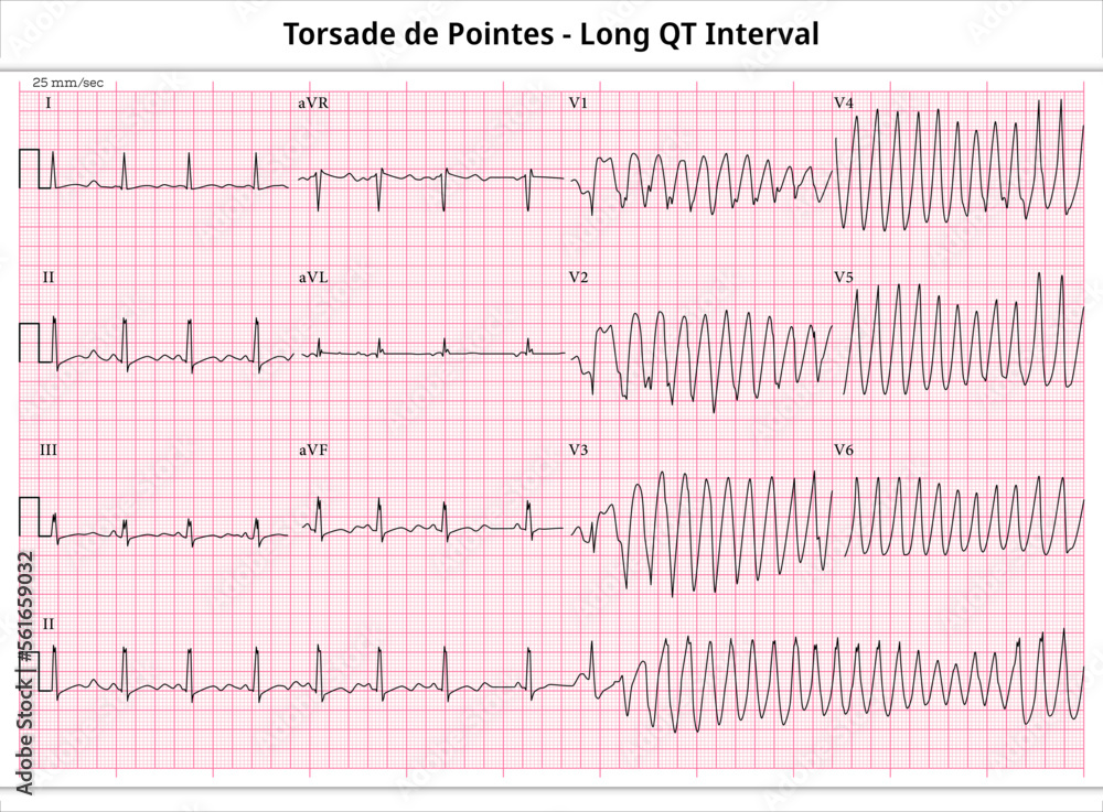 ECG Torsade de Pointes - Long QT Interval - Ventricular Tachycardia ...